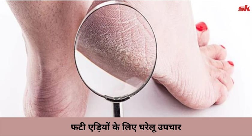 फटी एड़ियों के लिए घरेलू उपचार- Fati Ediyon Ke Lie Gharelu Upchar In Hindi