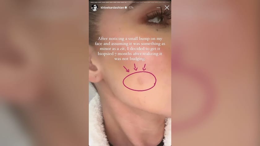 What happened to Khloe Kardashian? Skin cancer story and melanoma explored as reality star opens ...