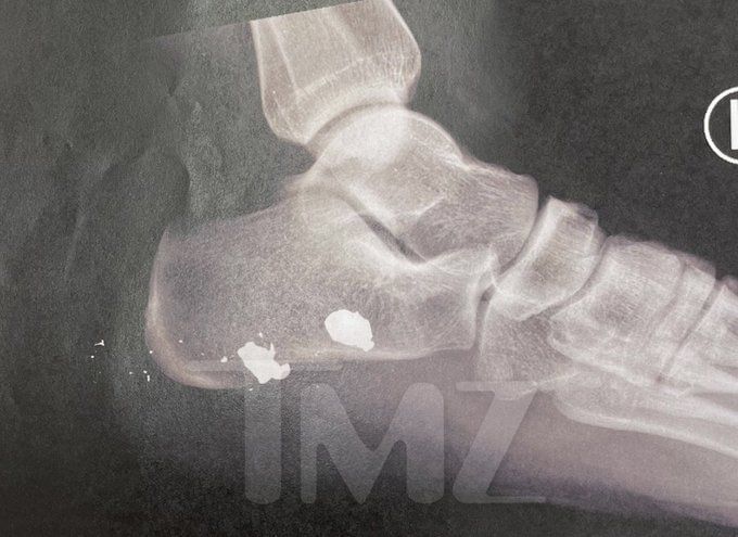 When was Megan Thee Stallion shot? Foot injury pictures surface from ...