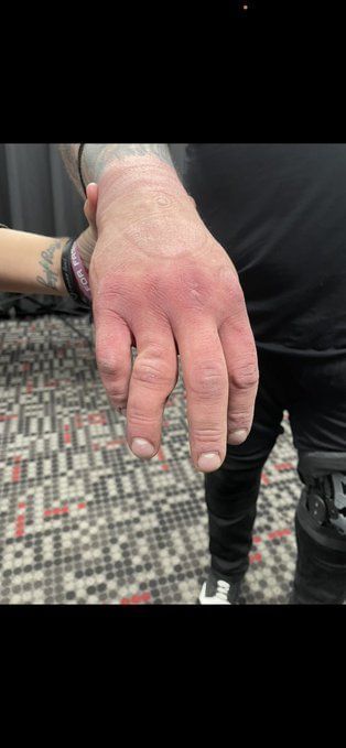 [PHOTO] Bray Wyatt shows off broken finger