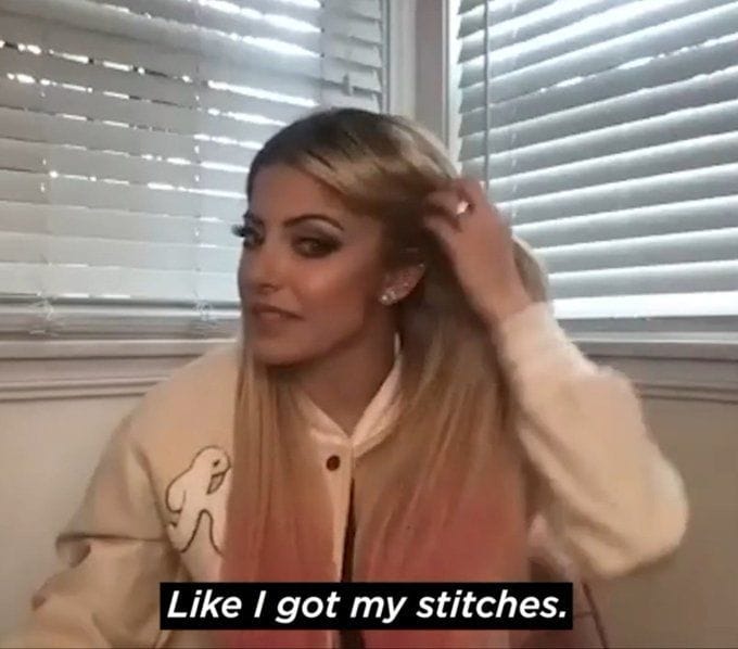 [PHOTO] Alexa Bliss shows off stitches on her face after skin procedure