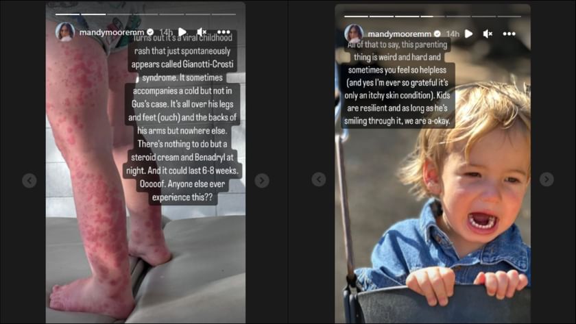 What is Gianotti-Crosti syndrome? Mandy Moore reveals son struggles ...