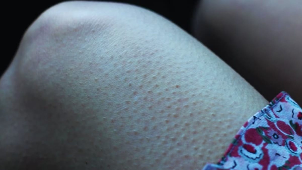 Conquer chicken skin with these dermatologist-approved methods