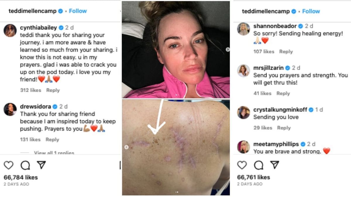 RHOBH alum Teddi Mellencamp reveals another melanoma amid her skin cancer battle