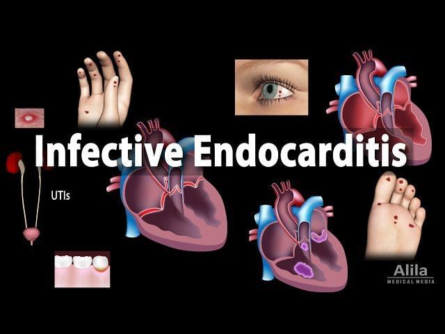 Bacterial Endocarditis: What is Bacterial Endocarditis? Symptoms ...