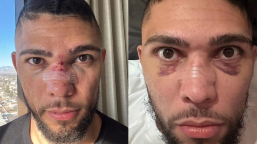 Johnny Walker provides latest update on serious nose injury he suffered ...