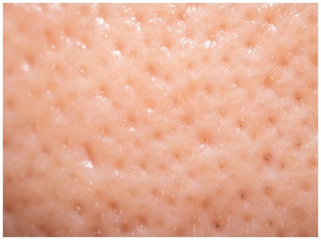 Understanding and Treating Strawberry Skin