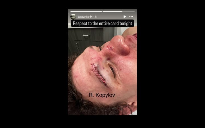 Dana White shares close-up before and after photos of gnarly eyebrow ...