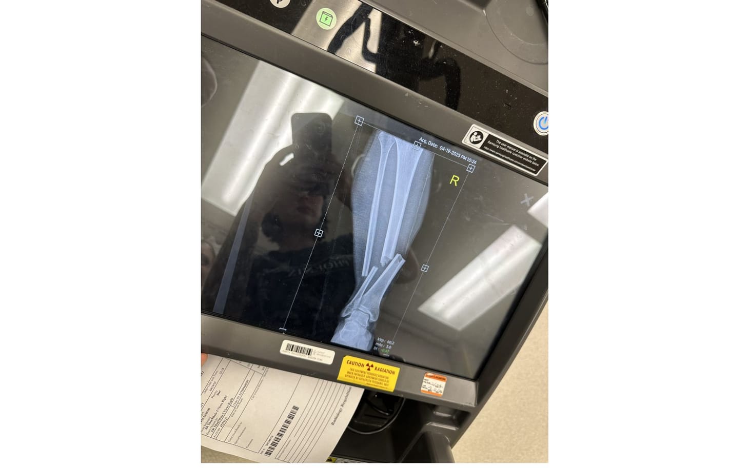 "That's a career ender": Fans shocked as MMA fighter's leg snaps and ...