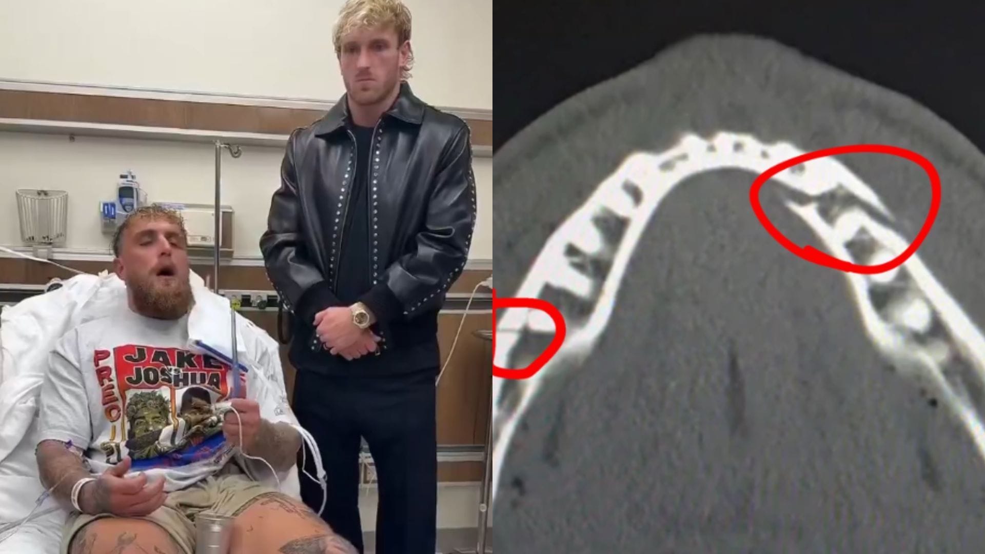 Jake Paul reveals double broken jaw diagnosis following KO loss against ...