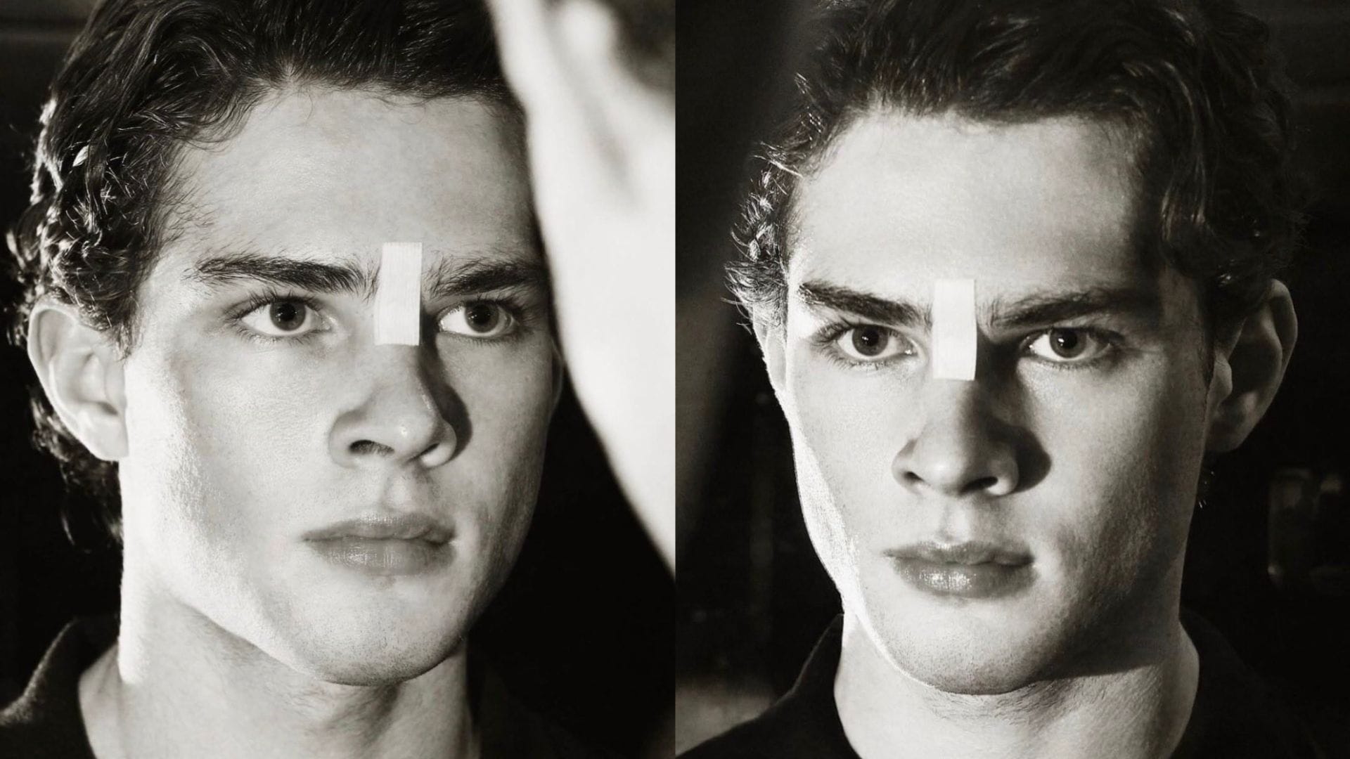 Clavicular before and after his nose surgery